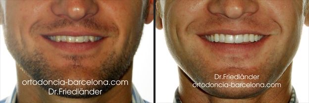 Tratamiento con Invisalign Full y elásticos (Clase II) - Caso 12 ...