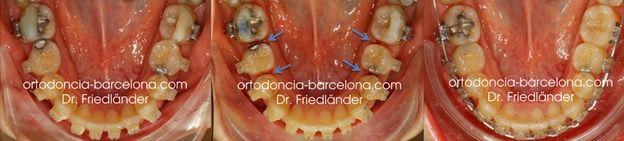 Tratamiento con brackets estéticos (Agenesias de segundos premolares ...